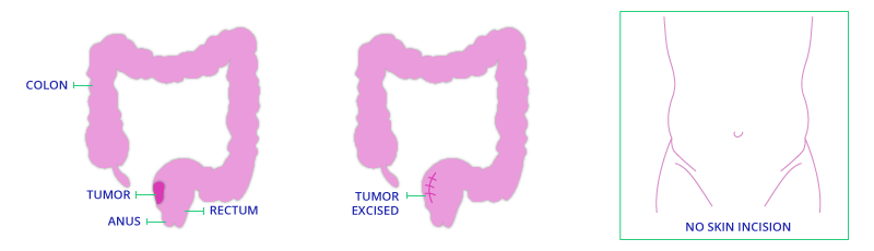What is TAMIS | Transanal Minimally Invasive Surgery