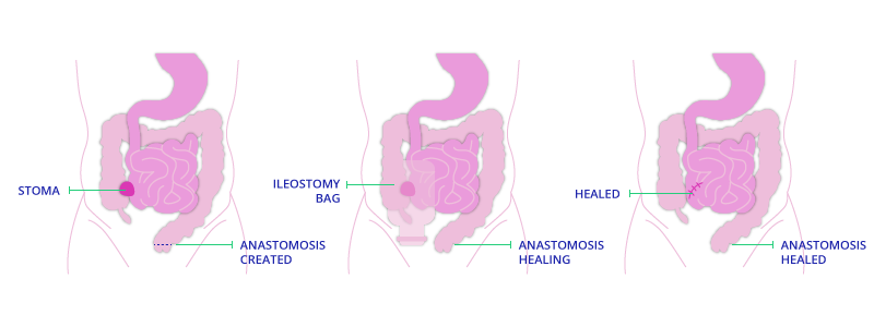 What is TAMIS | Transanal Minimally Invasive Surgery