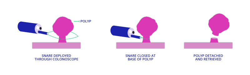 What is TAMIS | Transanal Minimally Invasive Surgery